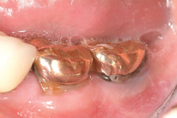 Clinical Technique for Core Buildups