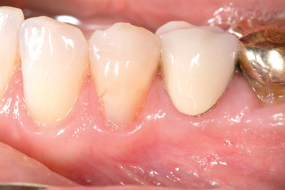 Clinical Technique for Core Buildups