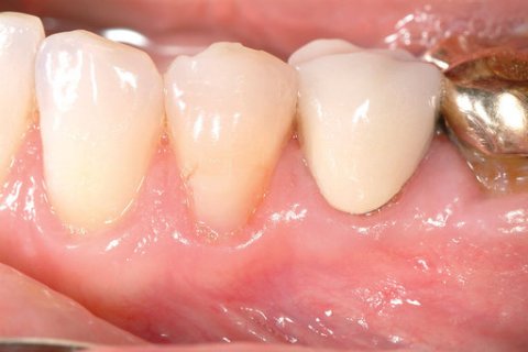 Clinical Technique for Core Buildups