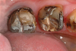 Clinical Technique for Core Buildups