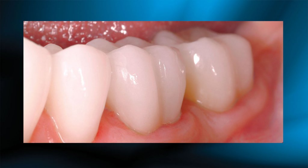 Clinical Technique for Core Buildups