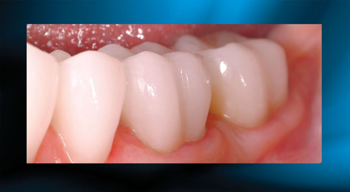 Clinical Technique for Core Buildups