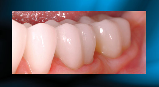 Clinical Technique for Core Buildups