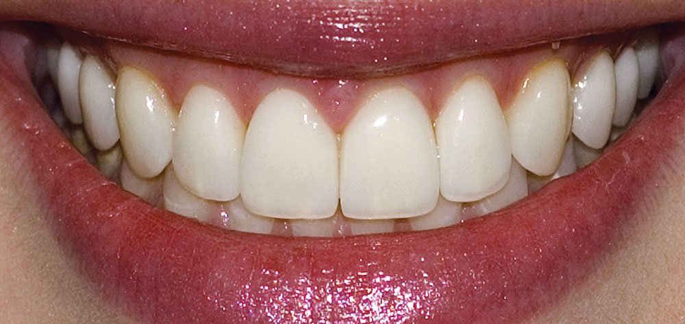 Using Margin Placement to Achieve the Best Anterior Restorative Esthetics