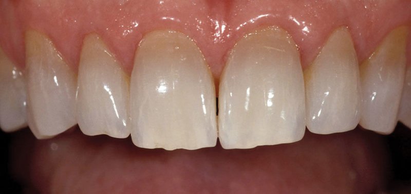 Using Margin Placement to Achieve the Best Anterior Restorative Esthetics