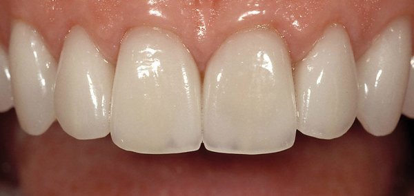 Using Margin Placement to Achieve the Best Anterior Restorative Esthetics