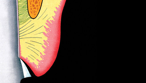 Using Margin Placement to Achieve the Best Anterior Restorative Esthetics
