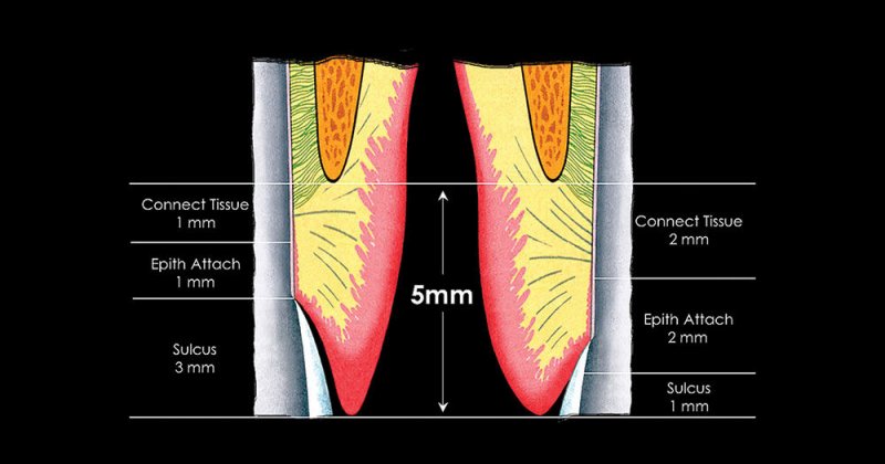Using Margin Placement to Achieve the Best Anterior Restorative Esthetics