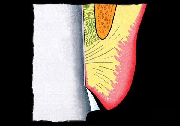 Using Margin Placement to Achieve the Best Anterior Restorative Esthetics