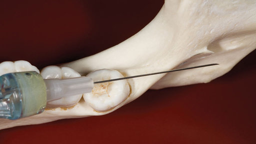 12 Alternatives to the Traditional Inferior Alveolar Nerve Block