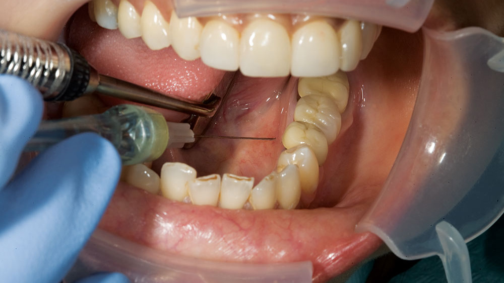 12 Alternatives to the Traditional Inferior Alveolar Nerve Block