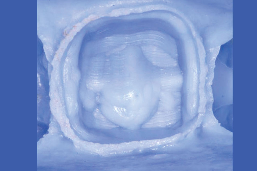 Clinical Predictability with Dual-Arch Impressions: Plastic Trays Are ...