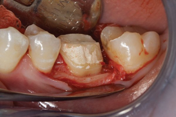 Biologic Shaping