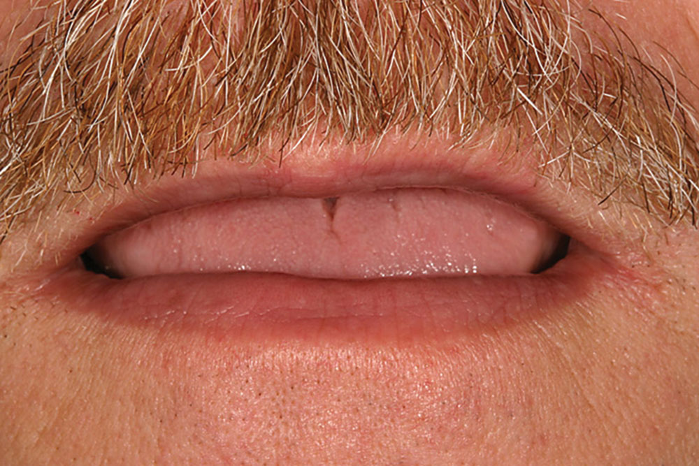 Too Much Tooth, Not Enough Tooth: Making Decisions About Anterior Tooth ...