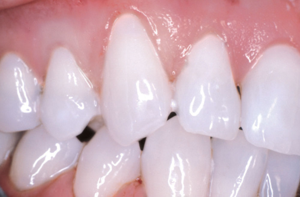 The Dentist's Involvement in Snoring and Sleep Apnea