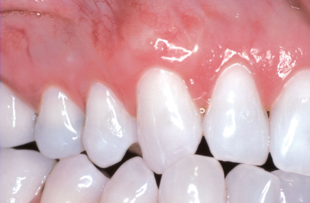 The Dentist's Involvement in Snoring and Sleep Apnea