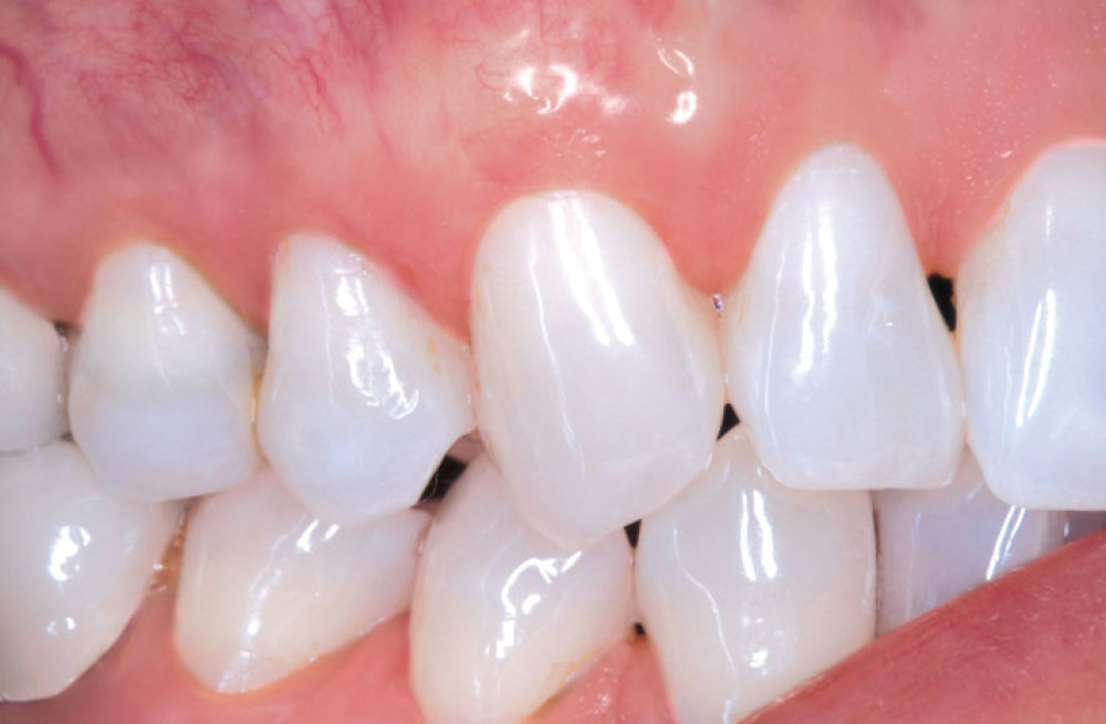 The Dentist's Involvement in Snoring and Sleep Apnea