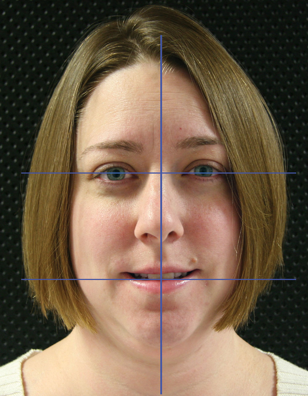 Simplifying Laboratory Communication: The Dental Midline Position ...