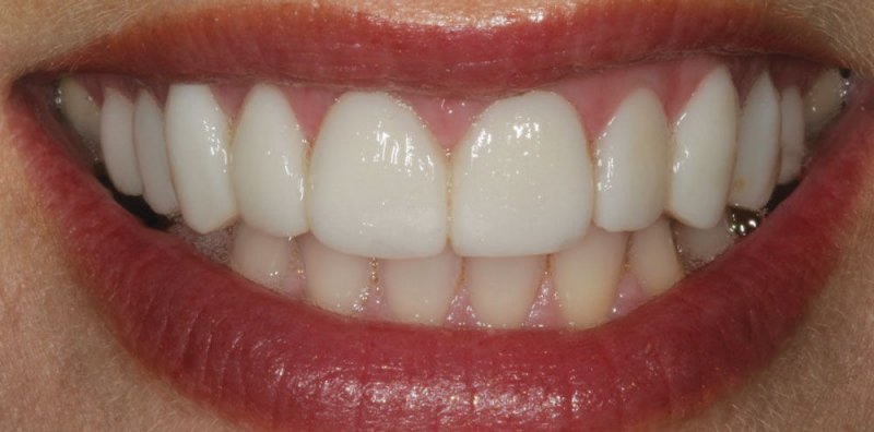 Simplifying Laboratory Communication: The Dental Midline Position ...