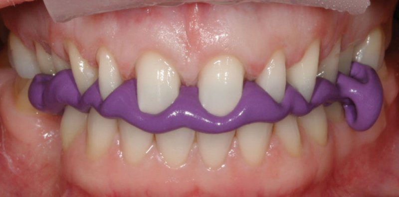 Simplifying Laboratory Communication: The Dental Midline Position ...