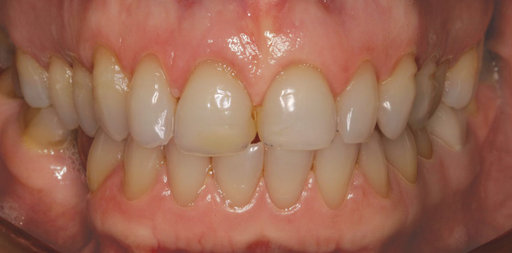 Simplifying Laboratory Communication: The Dental Midline Position ...