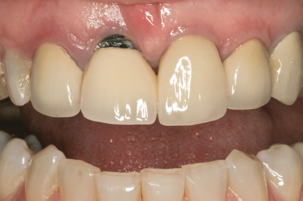 Monolithic Versus Bilayered Restorations: A Closer Look