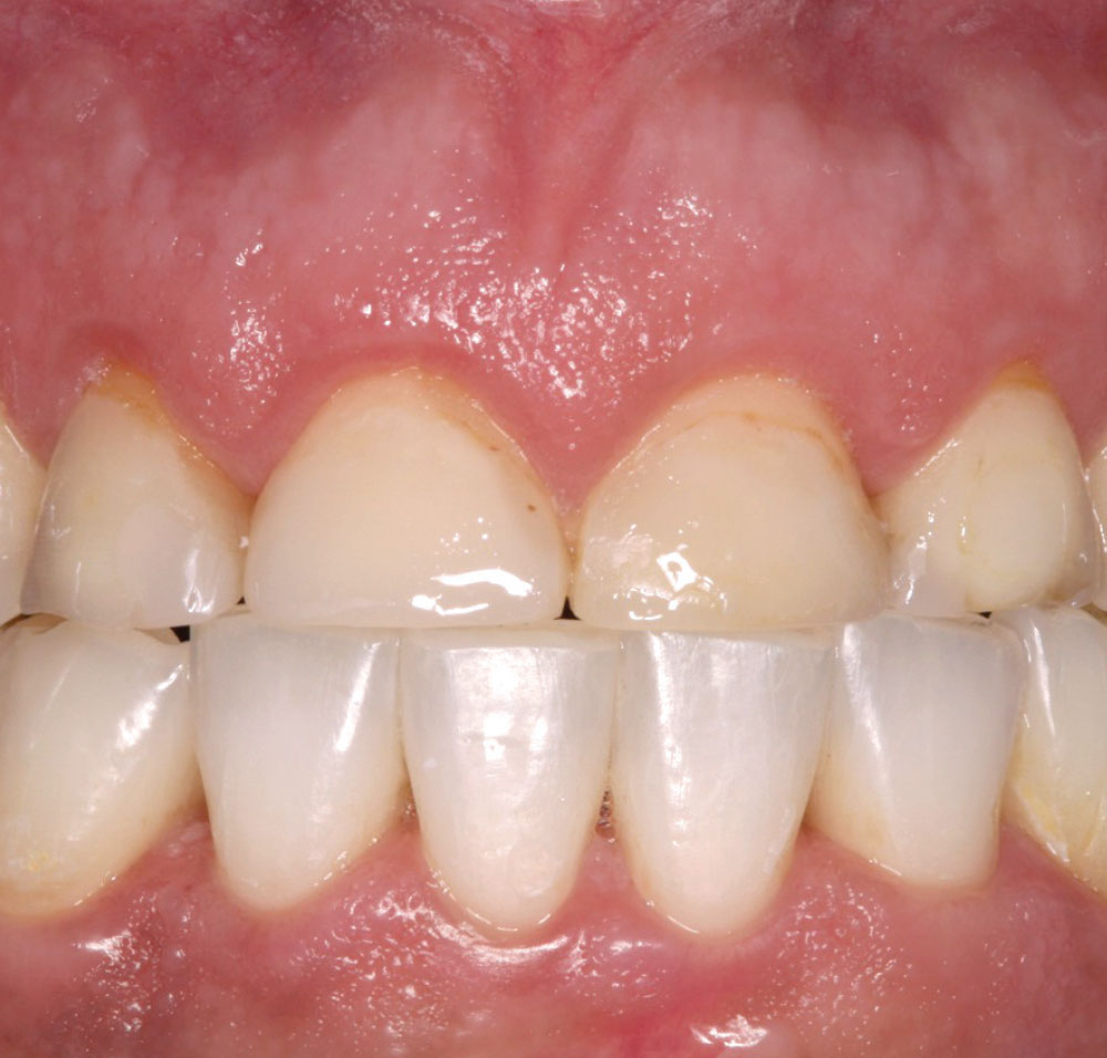 Periodontal Photo Essay: Is Closed-Flap Crown Lengthening a ...