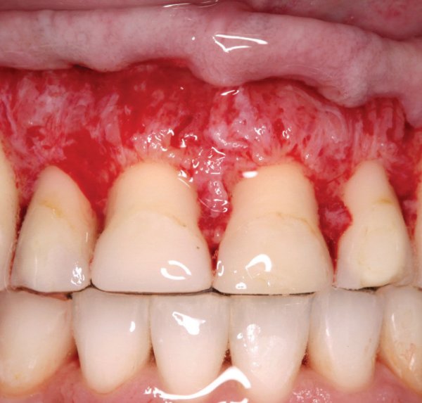 Periodontal Photo Essay: Is Closed-Flap Crown Lengthening a ...
