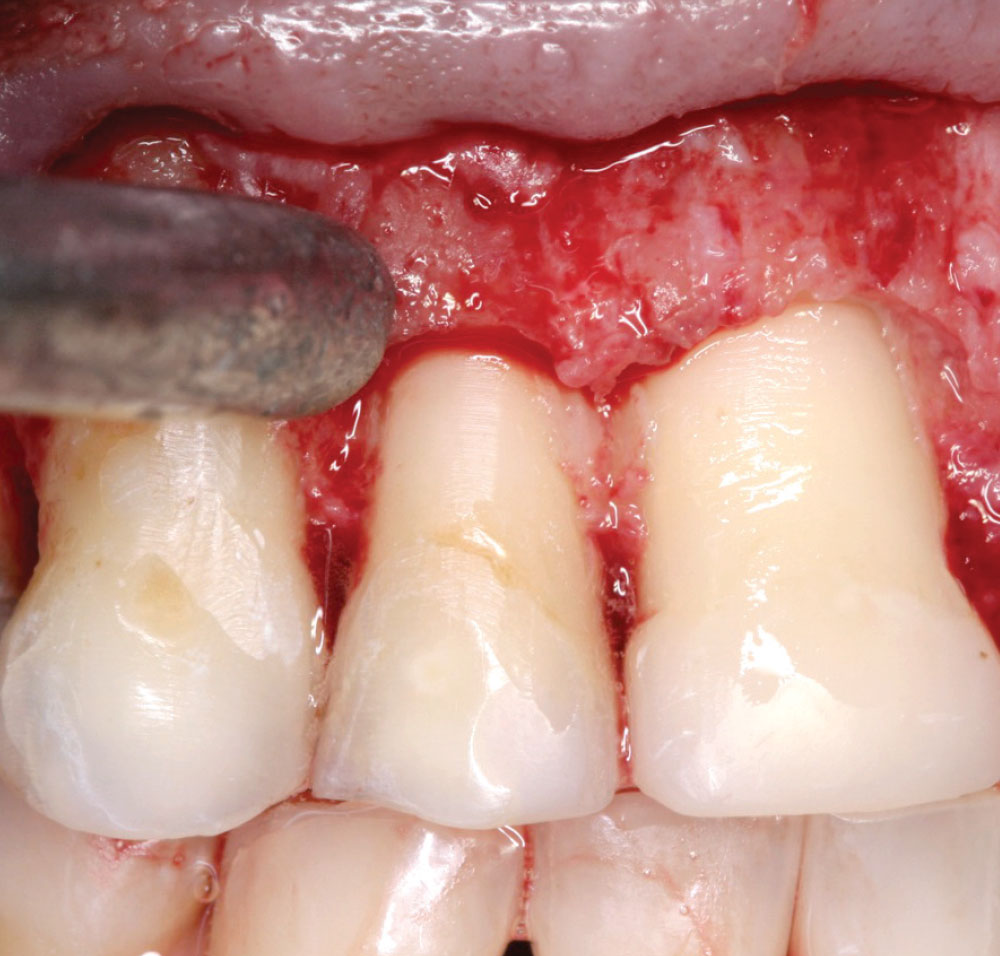 Periodontal Photo Essay: Is Closed-Flap Crown Lengthening a ...