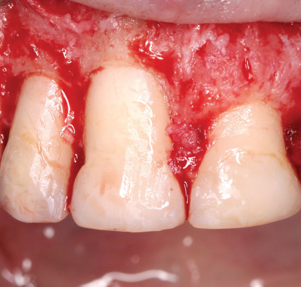 Periodontal Photo Essay: Is Closed-Flap Crown Lengthening a ...