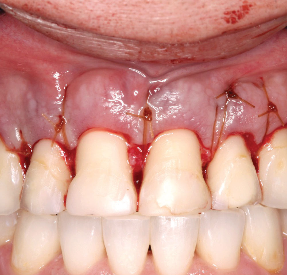 Periodontal Photo Essay: Is Closed-Flap Crown Lengthening a ...