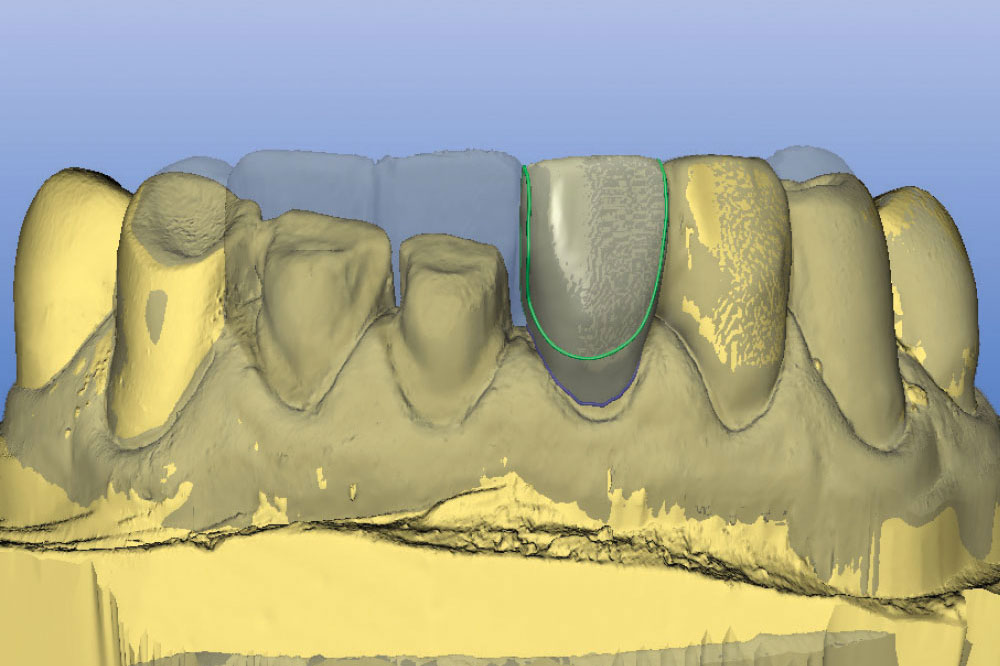 CEREC® Connect: A Welcomed Upgrade for CEREC Users