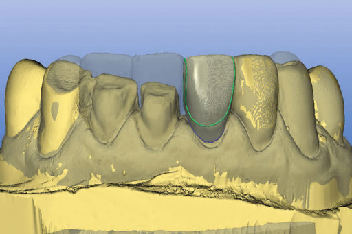 CEREC® Connect: A Welcomed Upgrade for CEREC Users