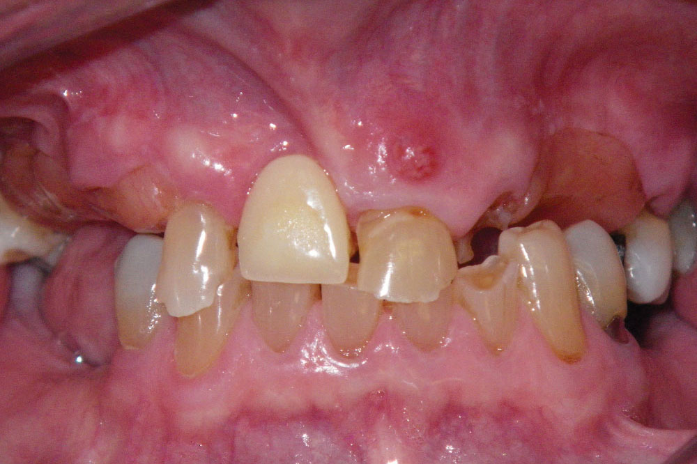 CEREC® Connect: A Welcomed Upgrade for CEREC Users