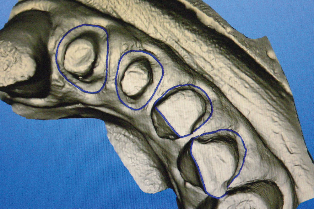 CEREC® Connect: A Welcomed Upgrade for CEREC Users