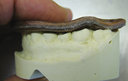 Optimizing Occlusal Results for Crown & Bridge Prostheses