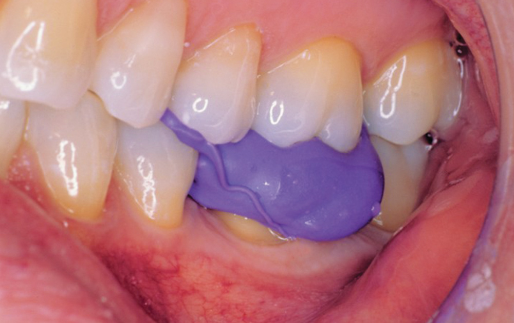 Optimizing Occlusal Results for Crown & Bridge Prostheses