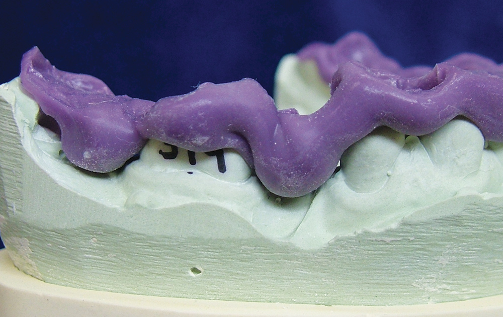 Optimizing Occlusal Results for Crown & Bridge Prostheses