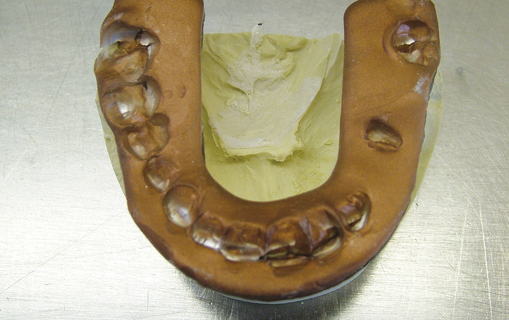 Optimizing Occlusal Results for Crown & Bridge Prostheses