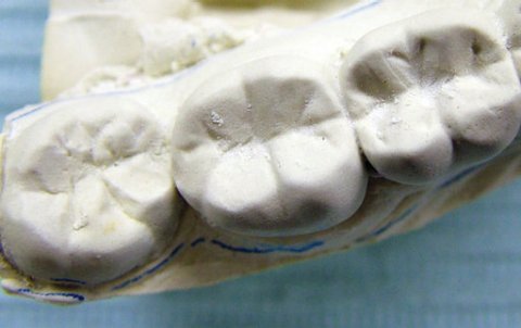 Optimizing Occlusal Results for Crown & Bridge Prostheses