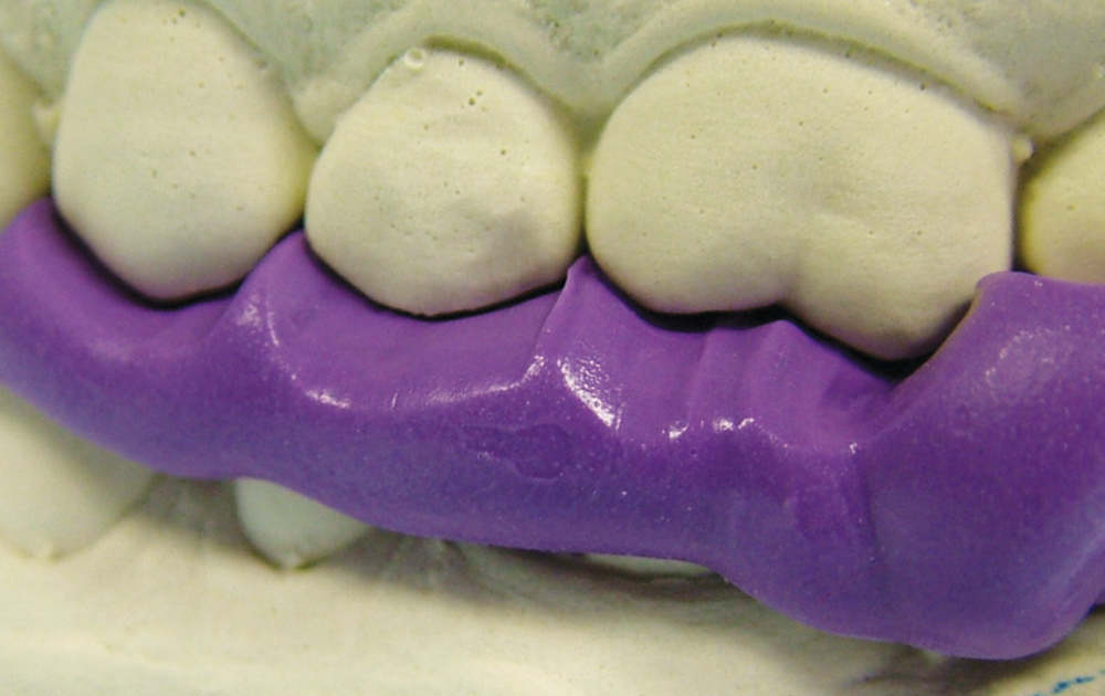 Optimizing Occlusal Results for Crown & Bridge Prostheses