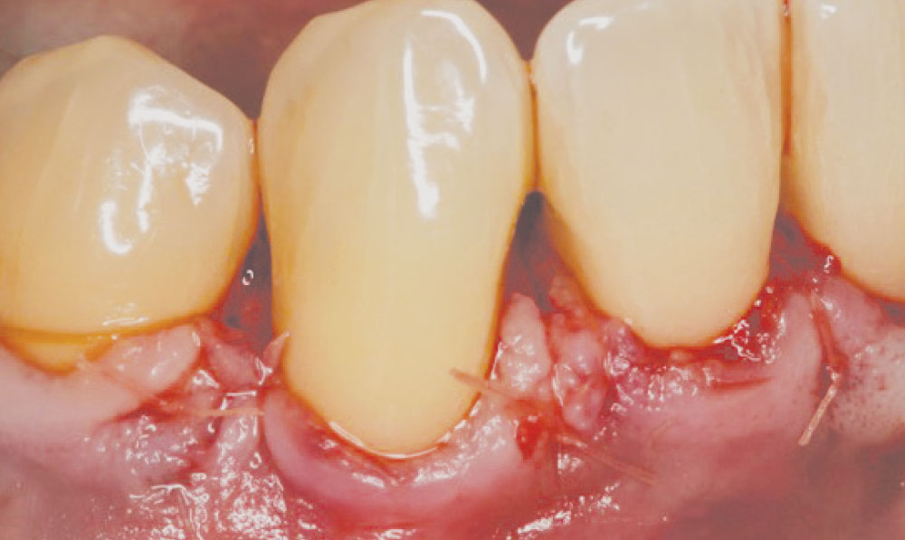 Dr. Daniel Melker on the Perio-Restorative Connection