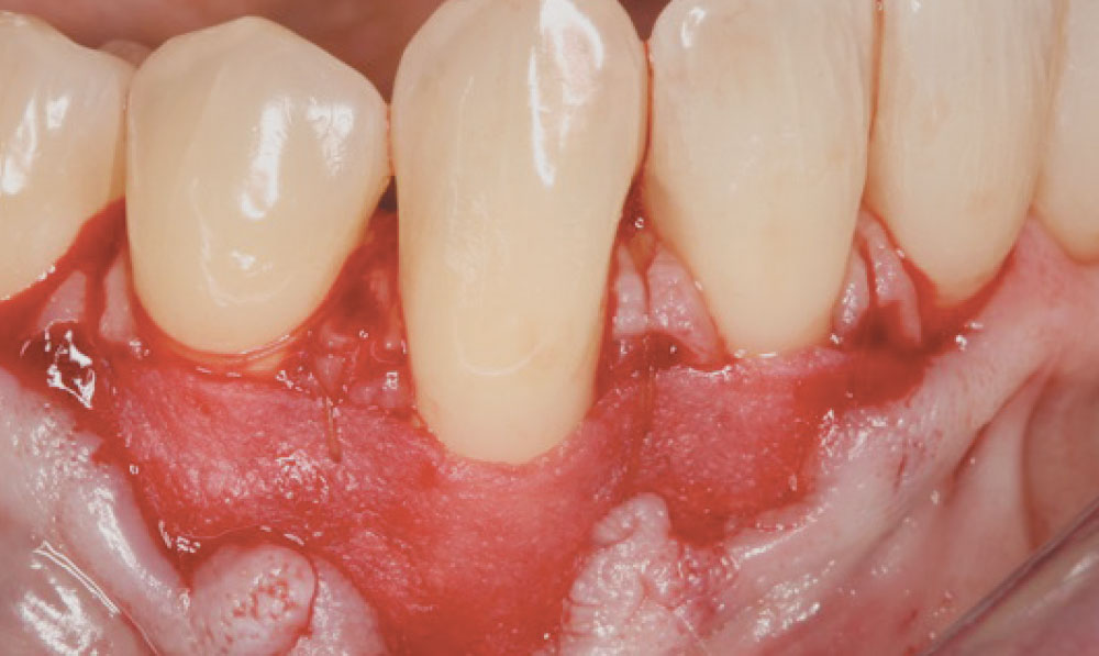 Dr. Daniel Melker on the Perio-Restorative Connection