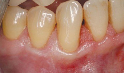 Dr. Daniel Melker on the Perio-Restorative Connection