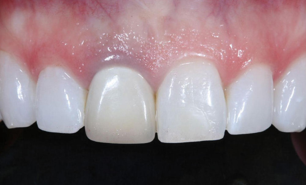 Aesthetic Treatment of Dark Root Syndrome