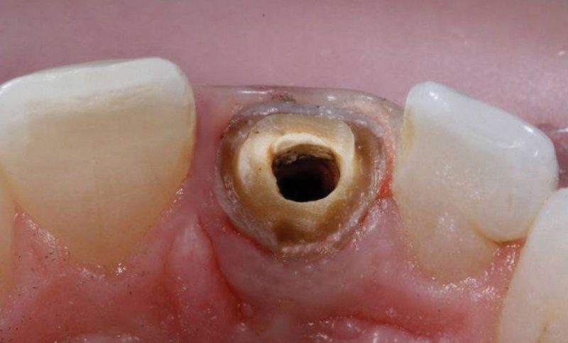 Aesthetic Treatment of Dark Root Syndrome