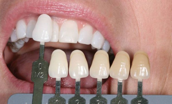 Aesthetic Treatment of Dark Root Syndrome