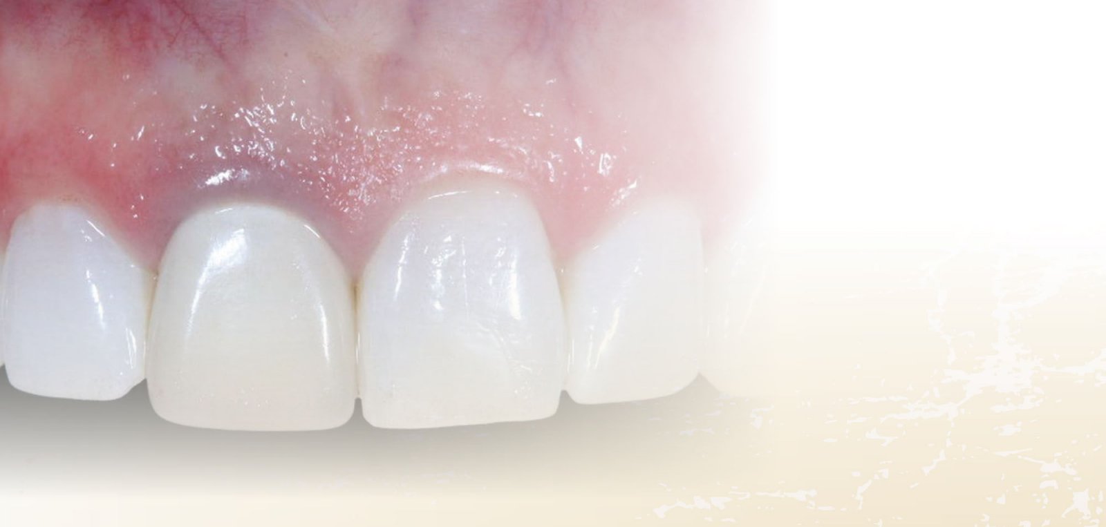 Aesthetic Treatment of Dark Root Syndrome