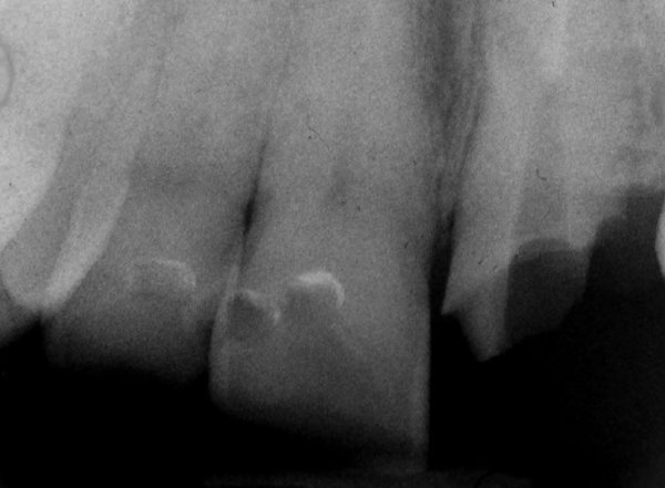 Clinical Predictability Using Fiber Posts