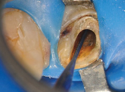 Clinical Predictability Using Fiber Posts